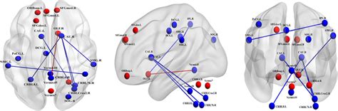 Altered Functional Connectivity Within The Network Of Disrupted Areas Download Scientific