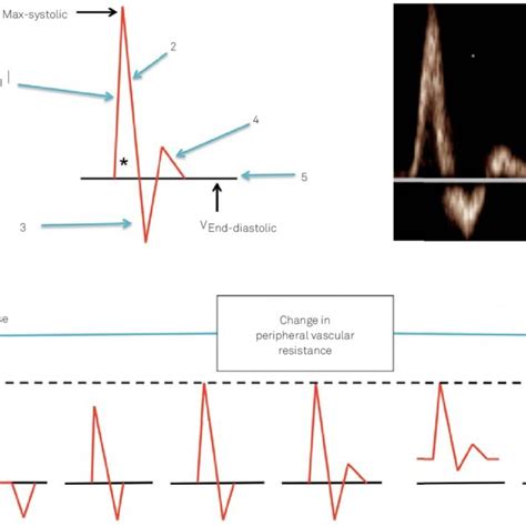 PDF Statement For Doppler Waveforms Analysis