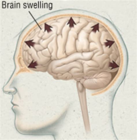 Brain Swelling After Stroke Is It Really Common And How Can It Be Managed Clinicspots