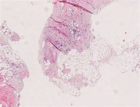 Invasive Lobular Carcinoma E Cadherinbeta Catenin Core Biopsy