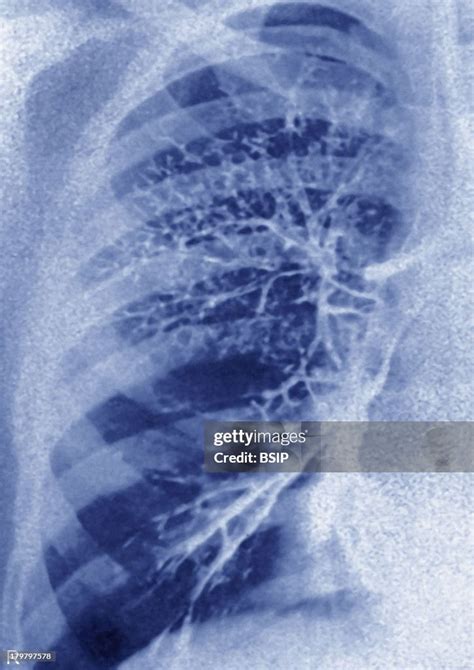 Bronchiectasis X Ray Bronchial Dilatation Pulmonary X Ray In Front