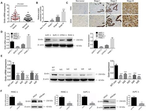 Expression Of Girdin In Pancreatic Cancer Tissues And Cell Lines A