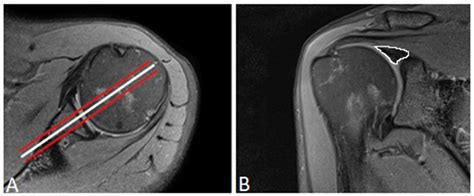 Shoulder Mri Without Contrast
