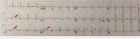 12 Lead Ecg Findings On Admission Showing St Segment Elevation Of The Download Scientific