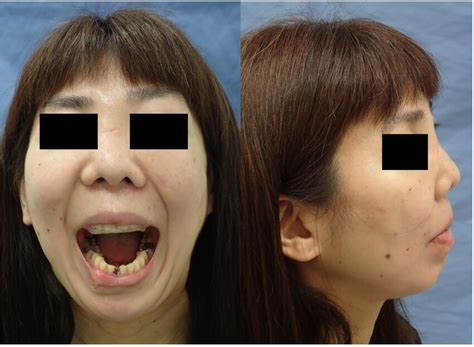 An Incisal Distance Of 35 Mm Has Been Achieved And The Patient Can Eat
