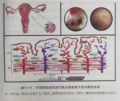 宫腔镜系列问答之——宫腔镜下分离粘连有哪些注意事项？