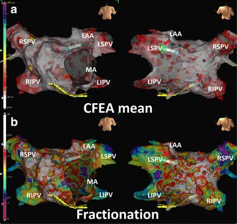 Difference Of Complex Fractionated Atrial Electrograms Cfaes Mean And Download Scientific