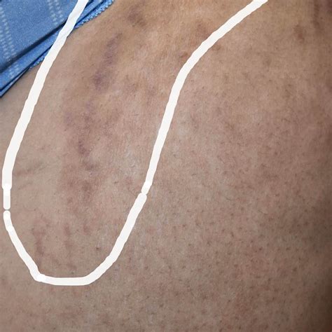 What Is Microneedling Gone Wrong And How To Prevent It