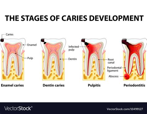 Pulpitis