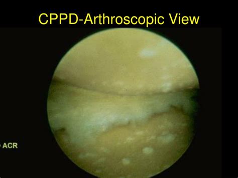 Ppt Crystal Induced Arthropathy Gout And Pseudogout Powerpoint Presentation Id1223805 Ppt Crystal Induced Arthropathy Gout And Pseudogout Powerpoint Presentation Id1223805