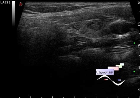 Richly Vascularized Thyroid Nodule Thyroid Gland Sonography Clinical
