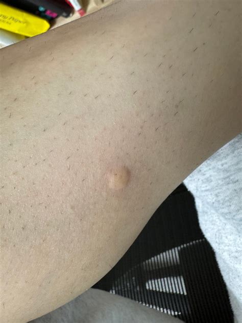 다리 벌레 물림 두드러기 지식in