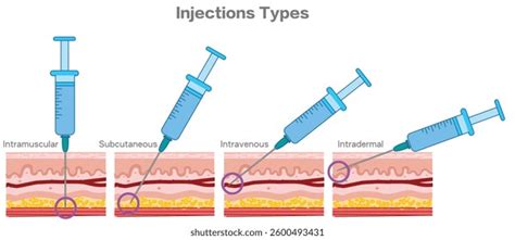 Intravenous Injection Angle Subcutaneous Injection Definition And