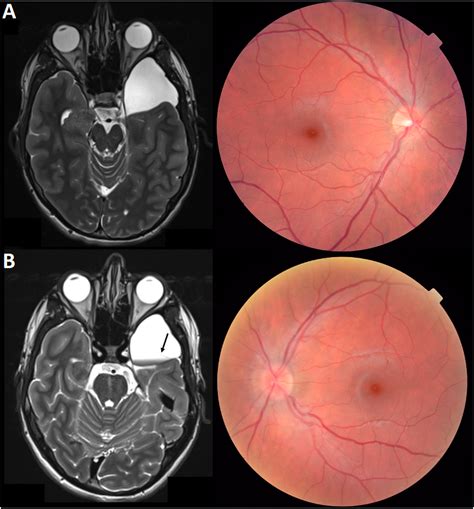Optic Nerve Edema In Pediatric Middle Cranial Fossa Arachnoid Cysts