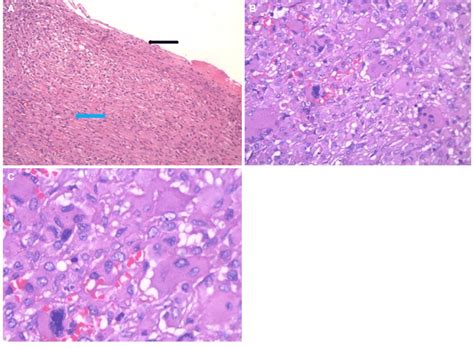 A Sheets Of Neoplastic Histiocytes Light Blue Arrow With Pleural