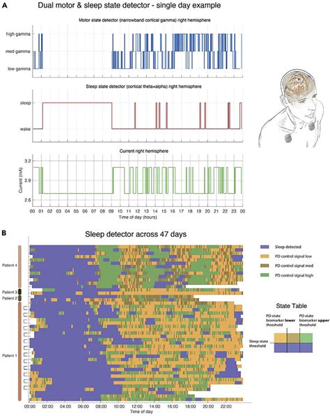 Fully Embedded Sleep Adaptive Closed Loop Dbs Control In A Patient With