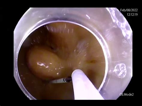 Mohamed Othman On Linkedin Tips After Full Thickness Resection For