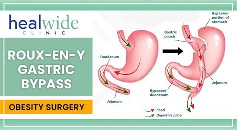 Gastric Bypass In Turkey Healwide Clinic