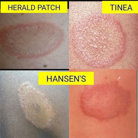 Medical Concepts Annular Lesions Annular Derm Hansen