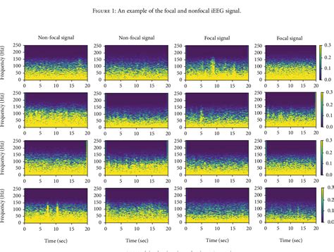 Figure 1 From Hybrid Convolutional Neural Network For Localization Of Epileptic Focus Based On