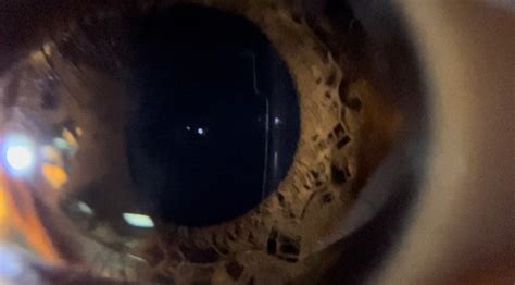 홍채 구멍 지식in