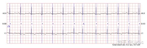 智能医疗1 ECG心电图基础 知乎