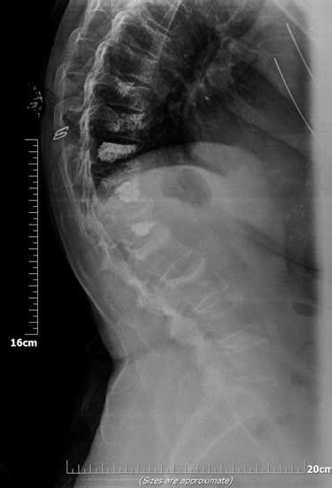 Preoperative Lateral Radiograph Of The Thoracolumbar Spine Showing