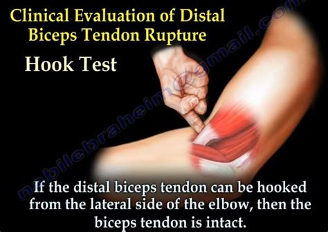 Biceps Tendon Rupture Wikem