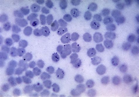 Free Picture Plasmodium Falciparum Rings Erythrocytes