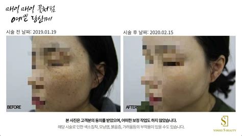 기미치료 전후사진 의사가 알려주는 기미가 치료가 안된다구요 기미없애는법 기미피부과 토닝 【대전세종청주천안