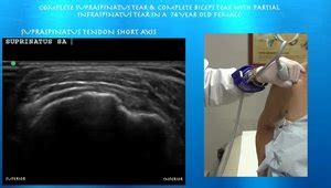 Complete Supraspinatus And Biceps Tears With A Partial Infraspinatus