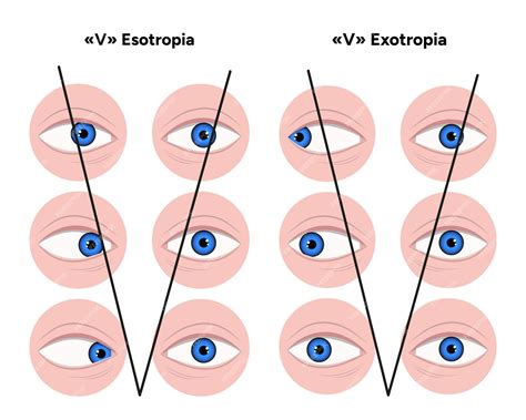 Premium Vector Types Of Strabismus V Esotropia And V Exotropia