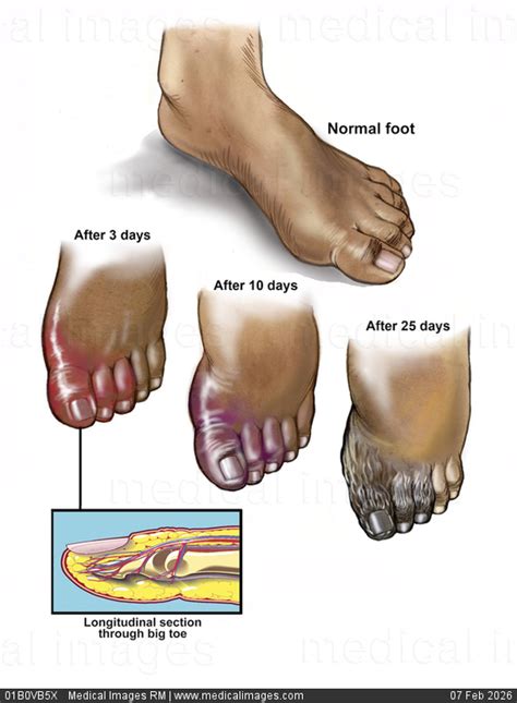 Stock Image Illustration Of Gangrene Of The Foot Showing Three Stages