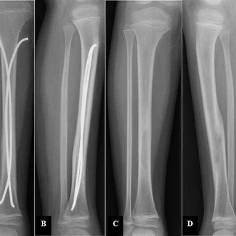 Radiographs Of The Left Tibia 6 Months After Elastic Intramedullary Download Scientific Diagram