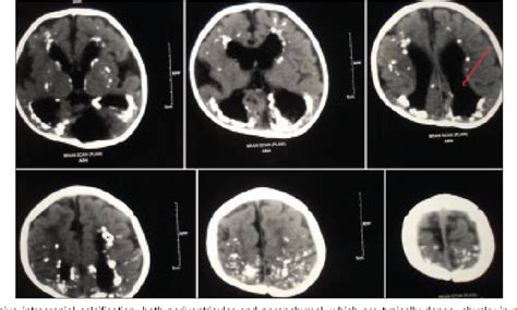 Figure 1 From Extensive Intracranial Calcification Of Pseudo Torch