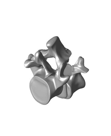 Spondy Grade 2 Listhesis Bennett Model Stl 3d Model By Orthopaedic Bones On Thangs