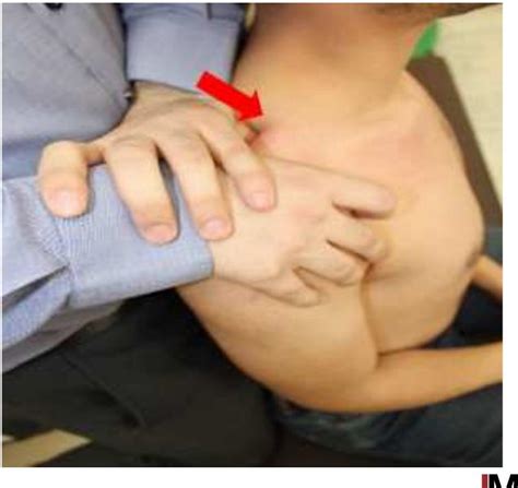 Fascial Distortion Model For Herniated Trigger Point