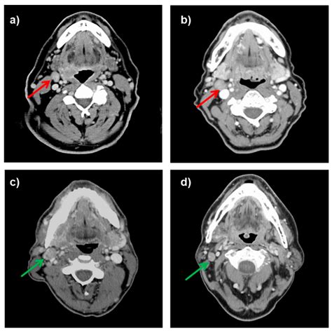 Cervical Lymph Nodes