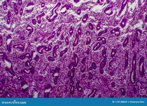 Endometrial Hyperplasia Light Micrograph Stock Image Image Of Glands