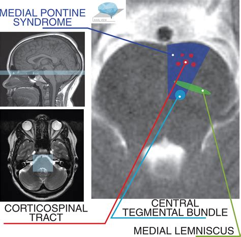 Midbrain Pons And Medulla Anatomy And Syndromesradiographics
