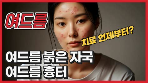 여드름 붉은자국 여드름흉터 치료 시기 언제부터 해야 할까요 Youtube