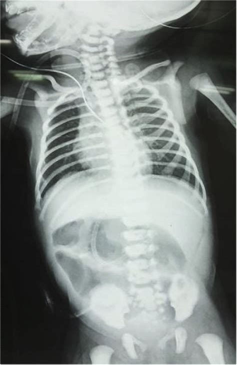 X Ray Abdomen Showing Few Dilated Bowel Loops Paucity Of Distal Gas Download Scientific