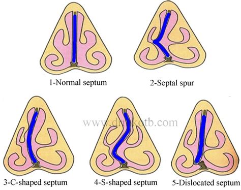 Deviated Septum Diagram