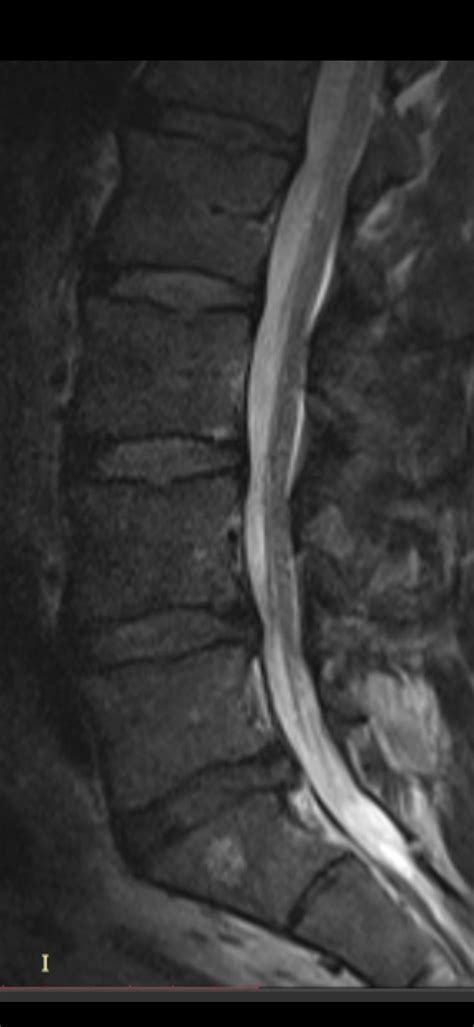 New Onset Sciatica While Walkingstanding Up Straight Really Dont