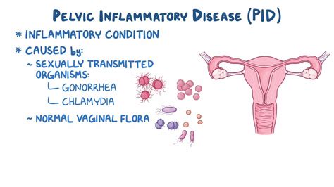 Pelvic Inflammatory Disease What Causes Pelvic Inflammatory Disease