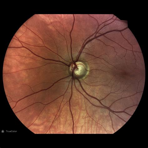 Fast And Easy Solution For Acquiring High Quality Retinal Images ICare