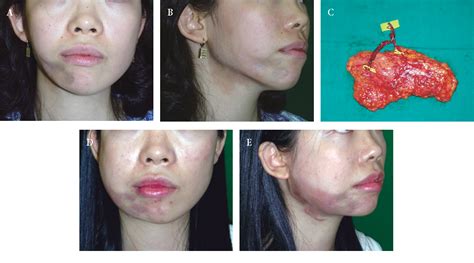 Figure 3 From Surgical Management Of Localized Scleroderma Semantic Scholar
