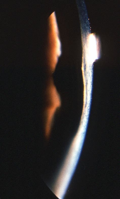 Lesson Pathologic Causes Of Irregular Astigmatism