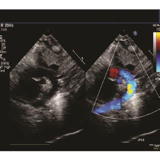 Echocardiogram Demonstrating Juxtaductal Coarctation Of The Aorta