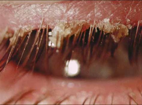 Squamous Blepharitis